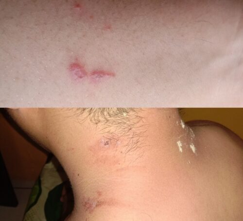 Cara Mencegah Iritasi Kulit yang Disebabkan oleh Semut Semai - Fight Bugs